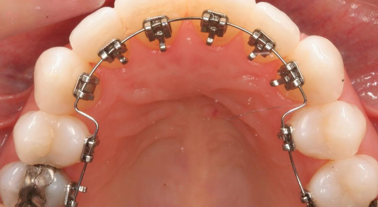 Ortodoncia dental: ¿Qué es y para qué sirve? – Clinica FL Dental